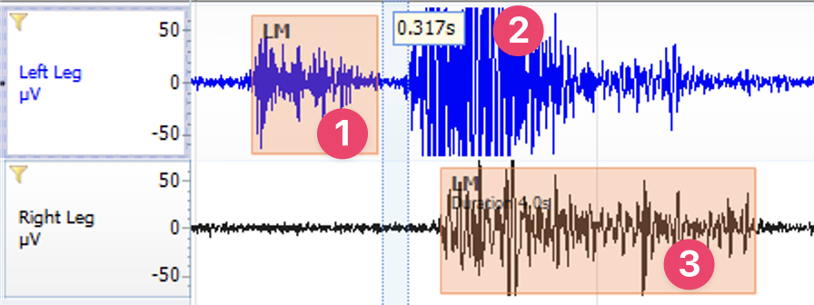 Scoring Limb Movements and Periodic Limb Movements in Noxturnal – Nox ...