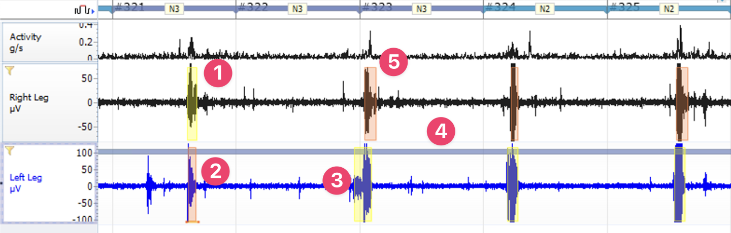 Scoring Limb Movements and Periodic Limb Movements in Noxturnal – Nox ...