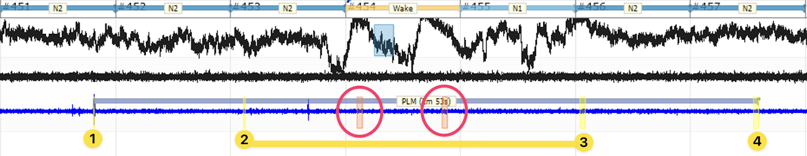 Scoring Limb Movements and Periodic Limb Movements in Noxturnal – Nox ...
