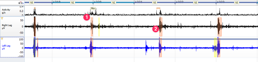 Scoring Limb Movements and Periodic Limb Movements in Noxturnal – Nox ...