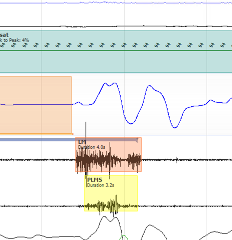 Scoring Limb Movements and Periodic Limb Movements in Noxturnal – Nox ...