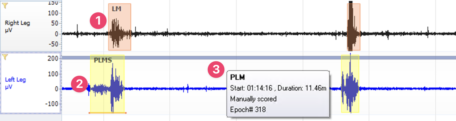 Scoring Limb Movements and Periodic Limb Movements in Noxturnal – Nox ...