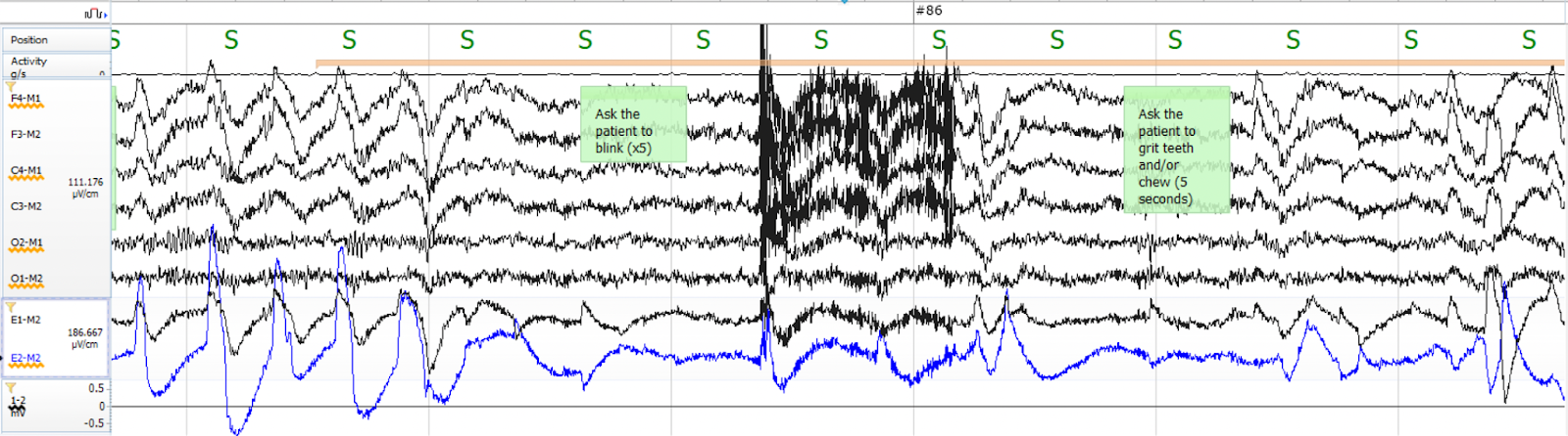 Performing Bio-calibrations with Noxturnal and Noxturnal App – Nox Support