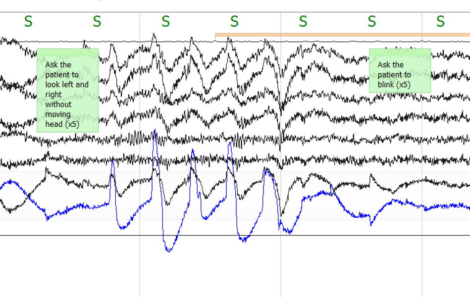 Performing Bio-calibrations with Noxturnal and Noxturnal App – Nox Support